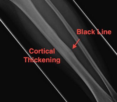Tibial Stress Fractures | The Bone School