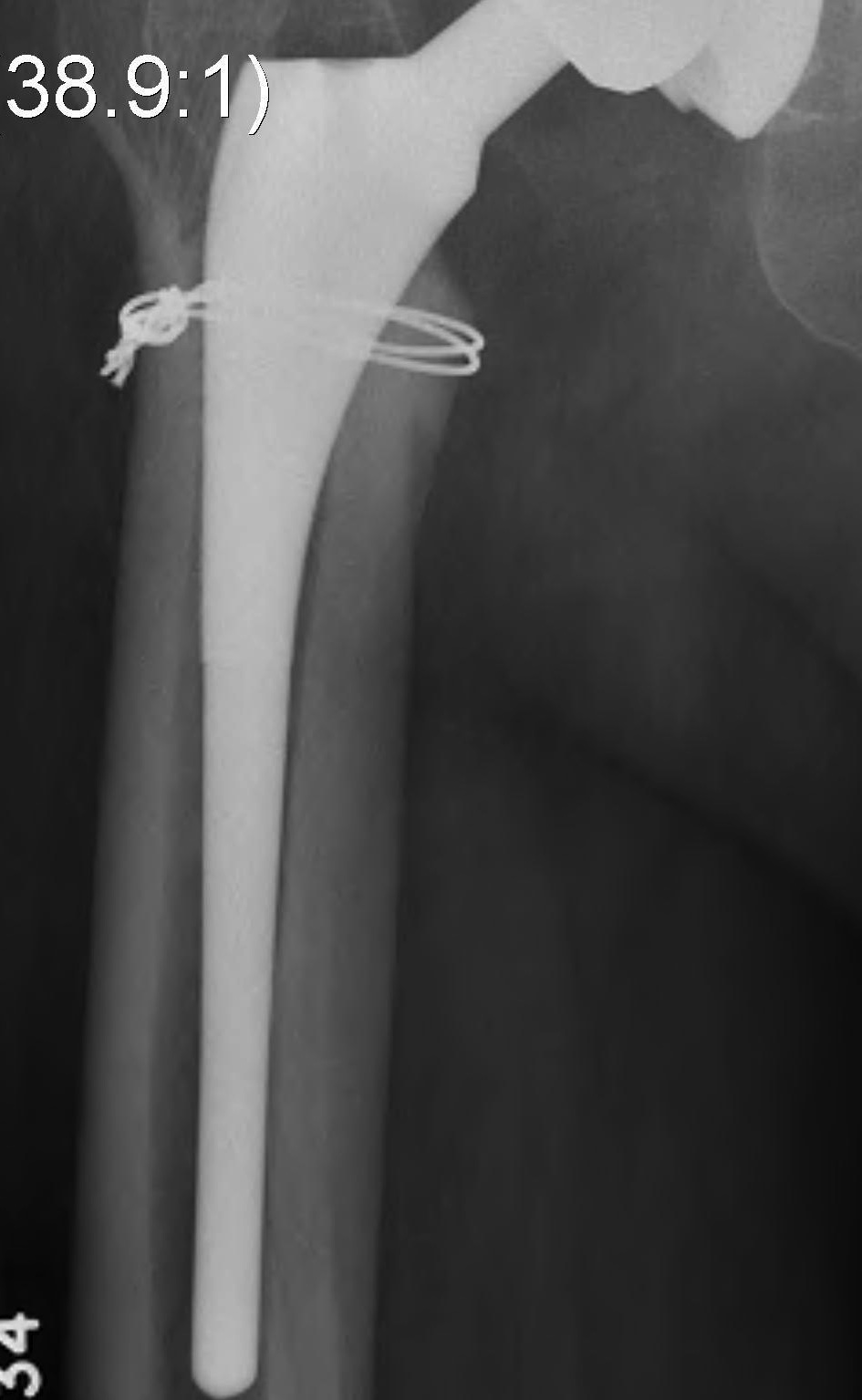 Intra-operative fracture | The Bone School