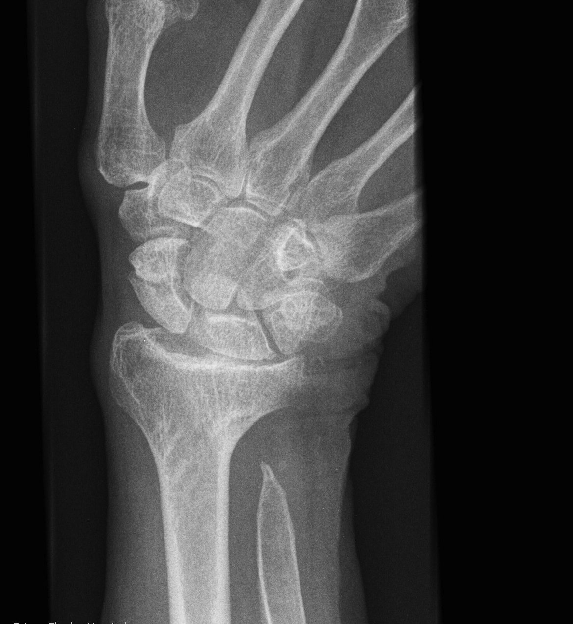 Rheumatoid Wrist | The Bone School