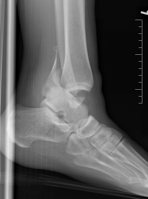 Displaced Trimalleolar Ankle Fracture