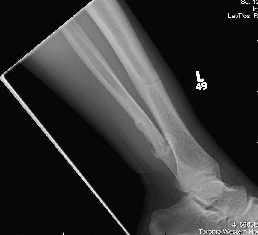 Tibial Stress Fractures | The Bone School
