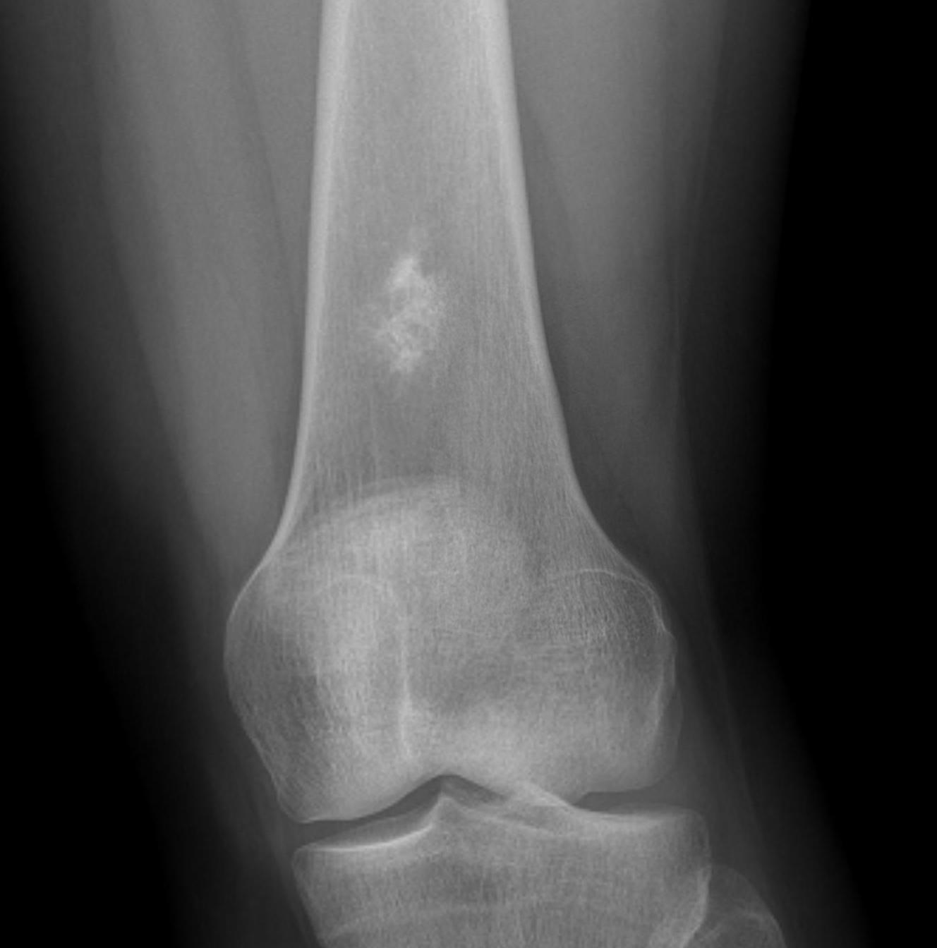 Enchondroma | The Bone School