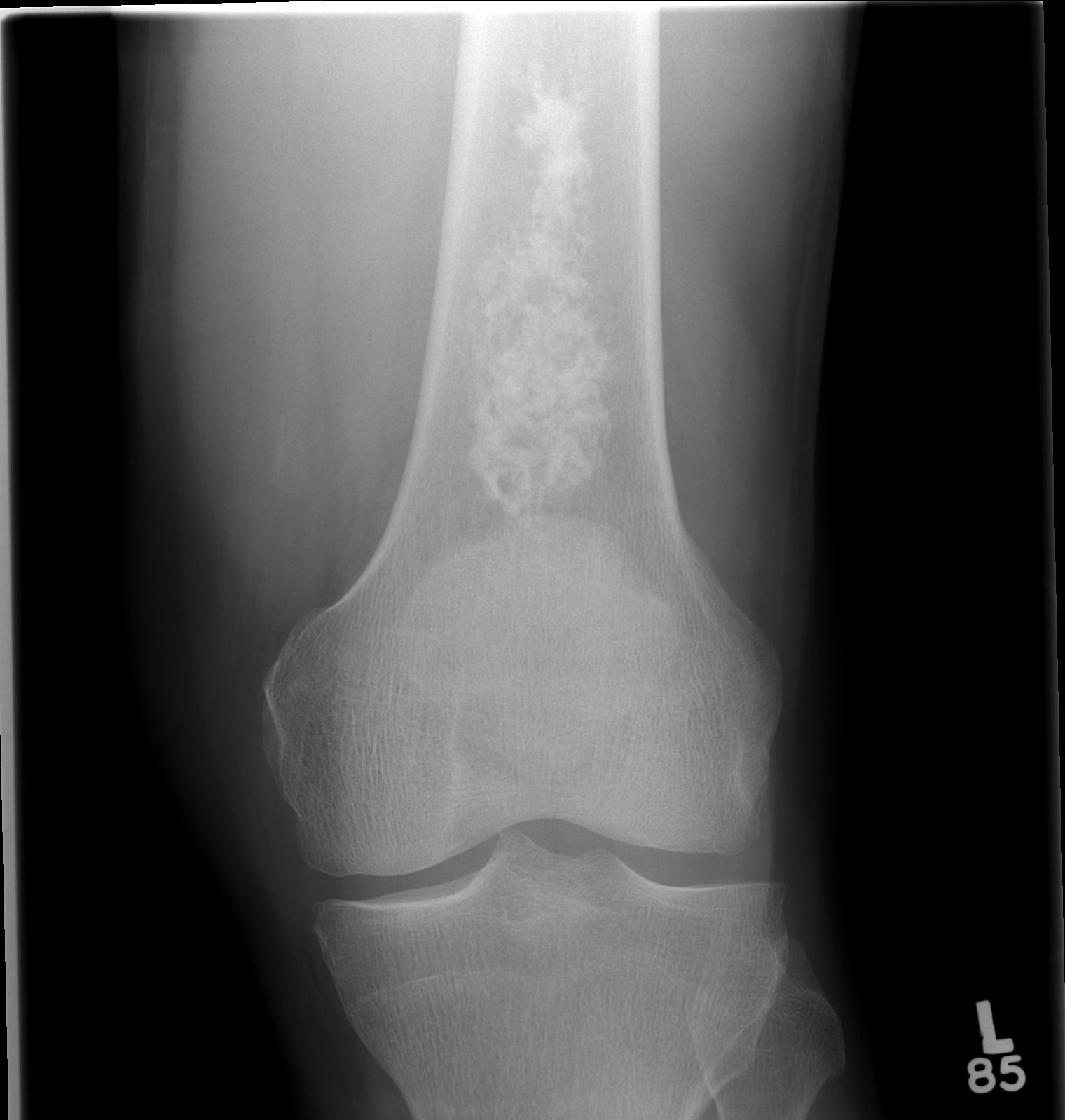 Enchondroma | The Bone School