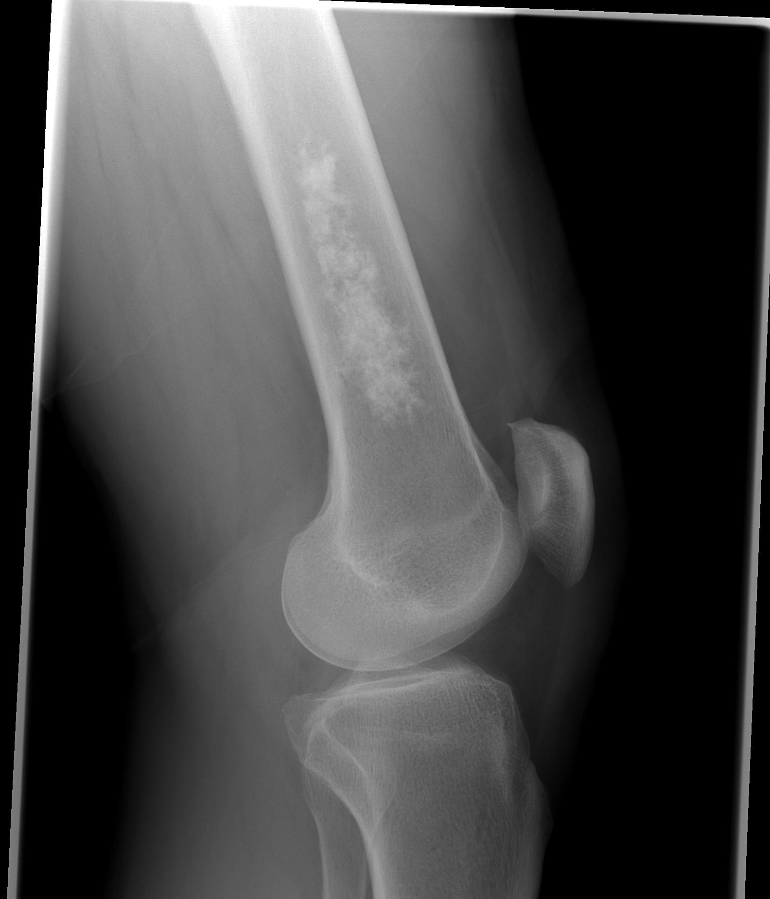 Enchondroma | The Bone School