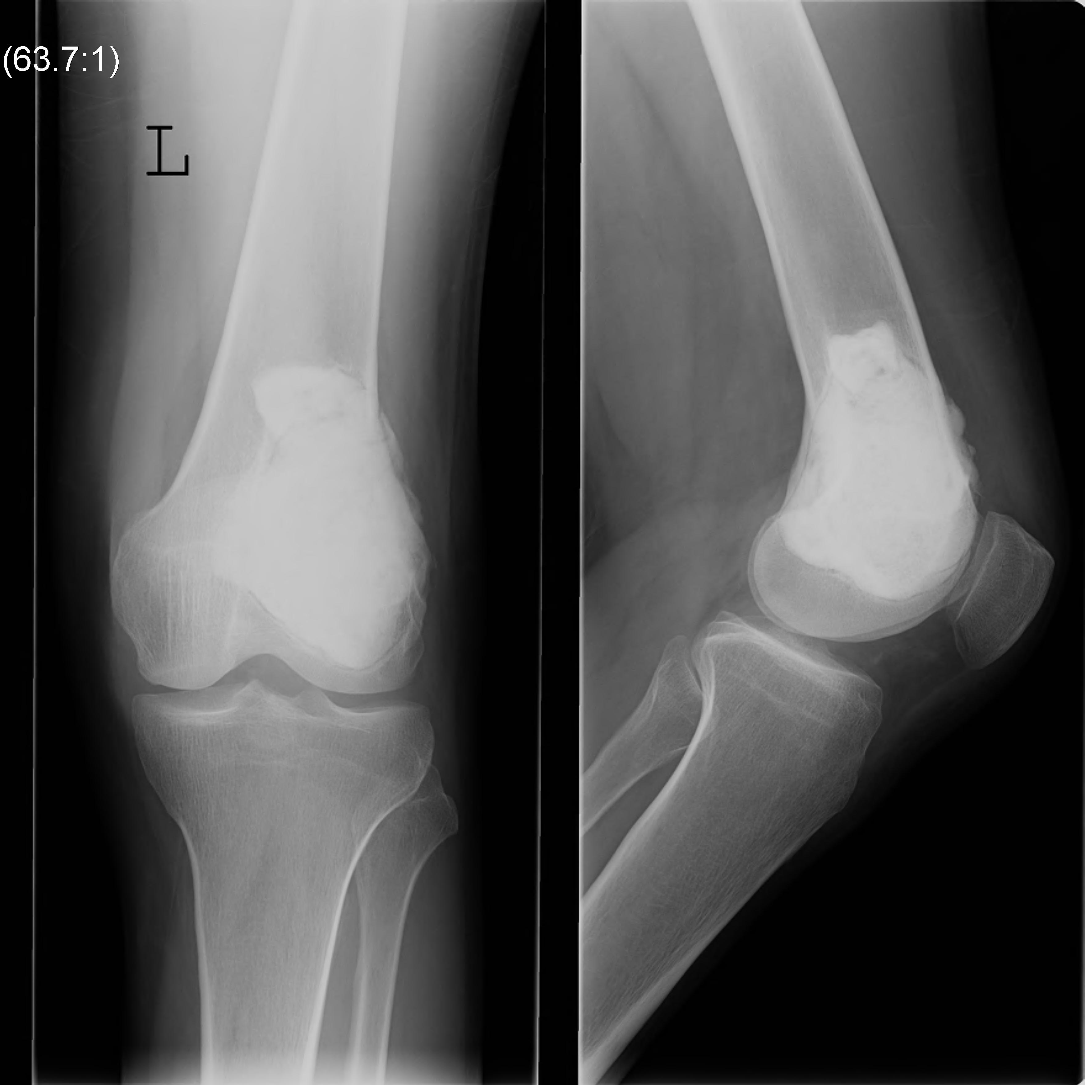 Giant Cell Tumour | The Bone School