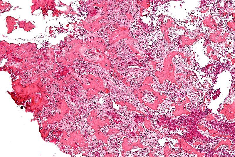 Osteoid Osteoma | The Bone School
