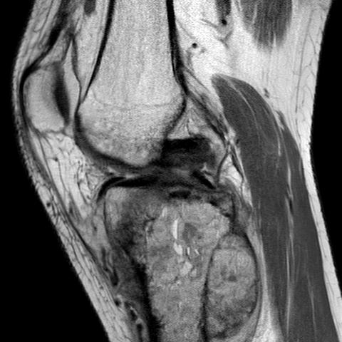Conventional Osteosarcoma | The Bone School