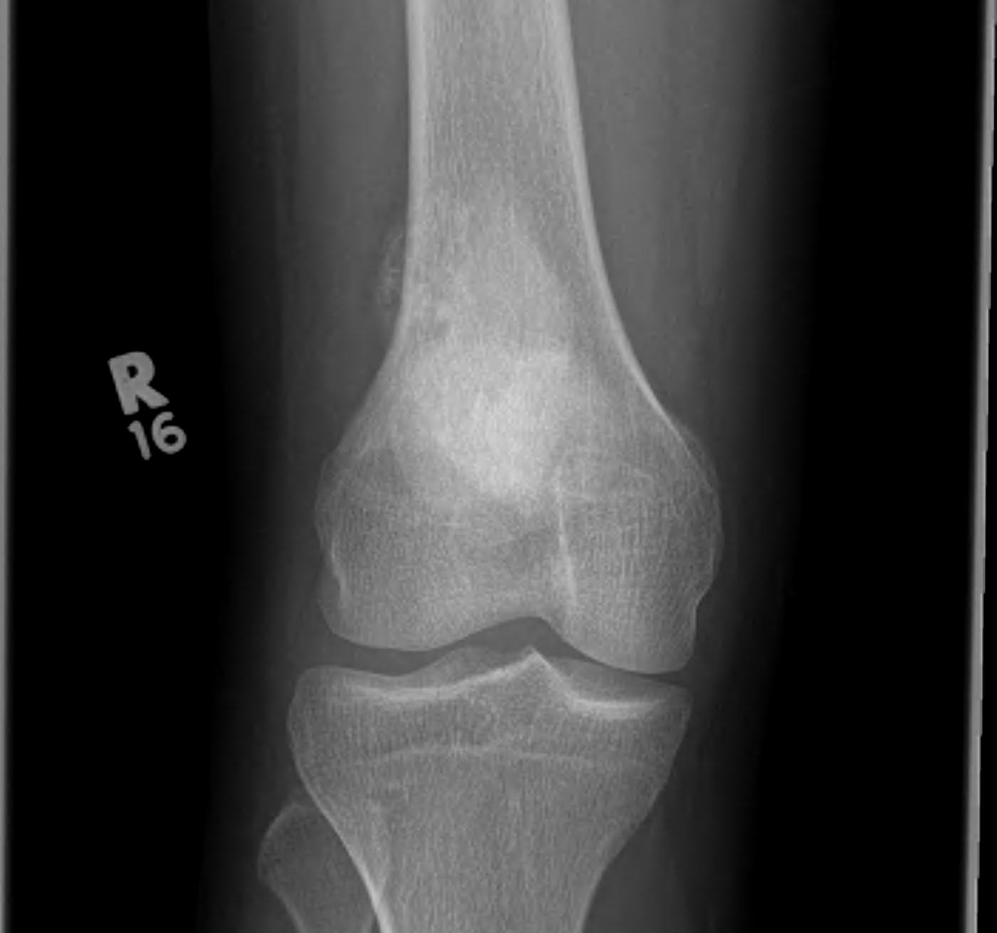 Osteosarcoma Knee Mri