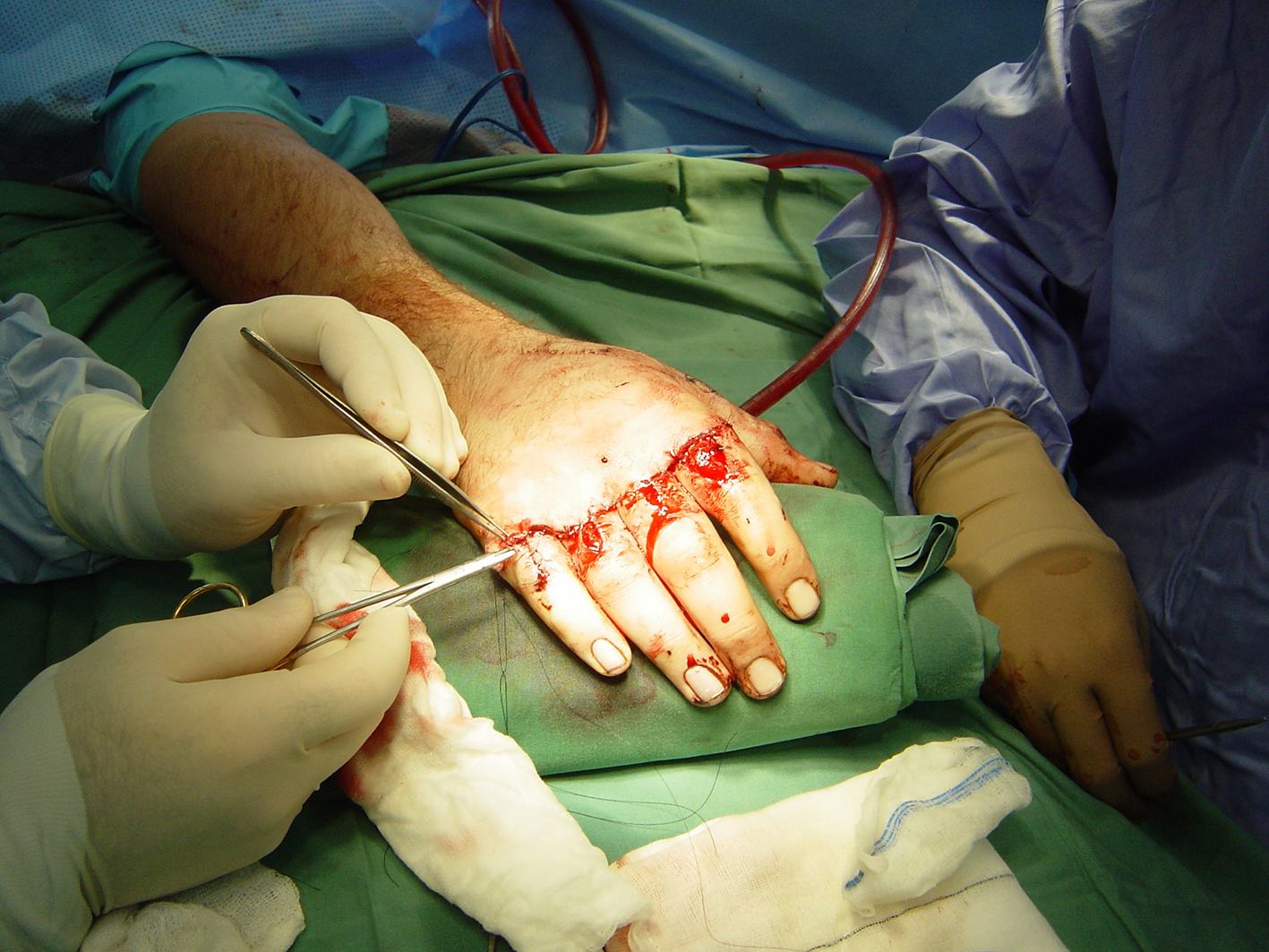 major limb replantation | The Bone School