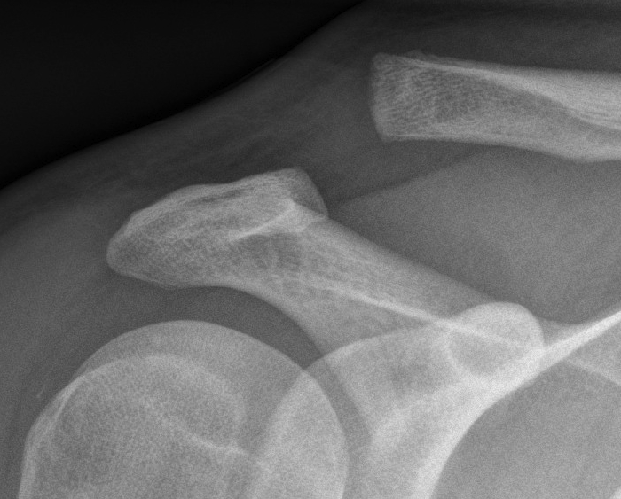 suspensory fixation | The Bone School