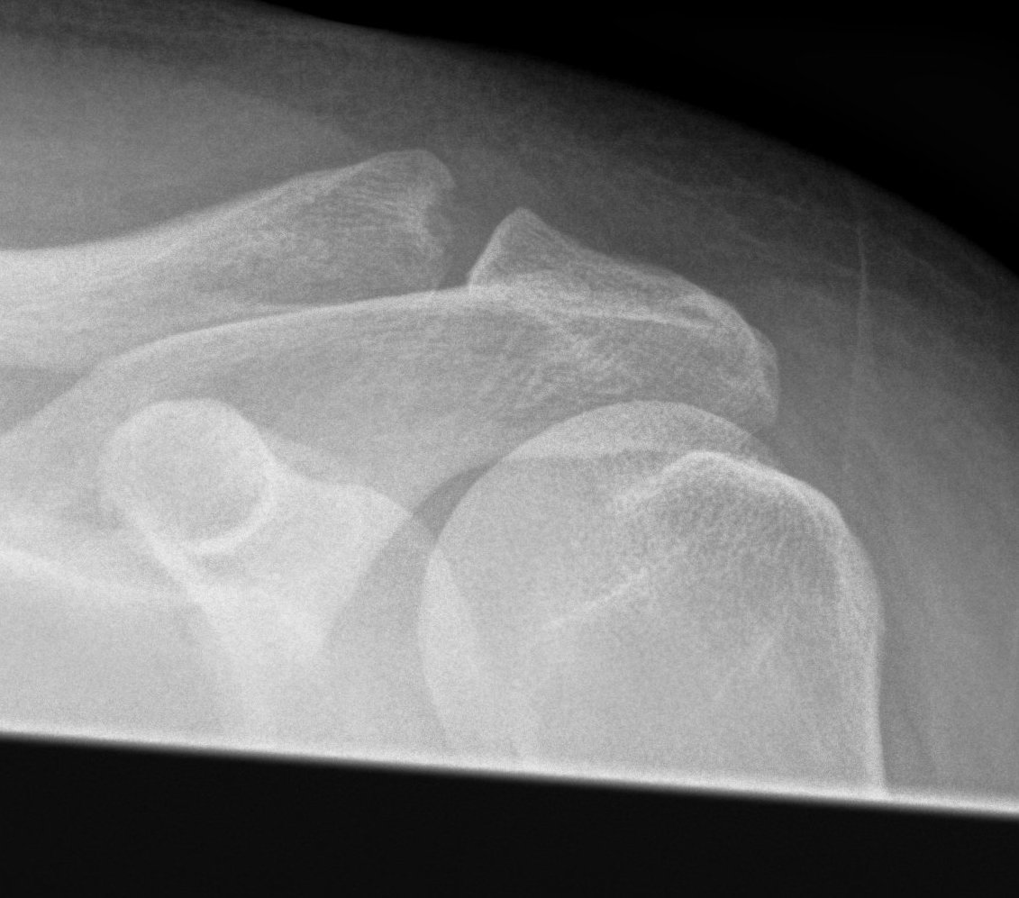 ACJ Osteoarthritis | The Bone School