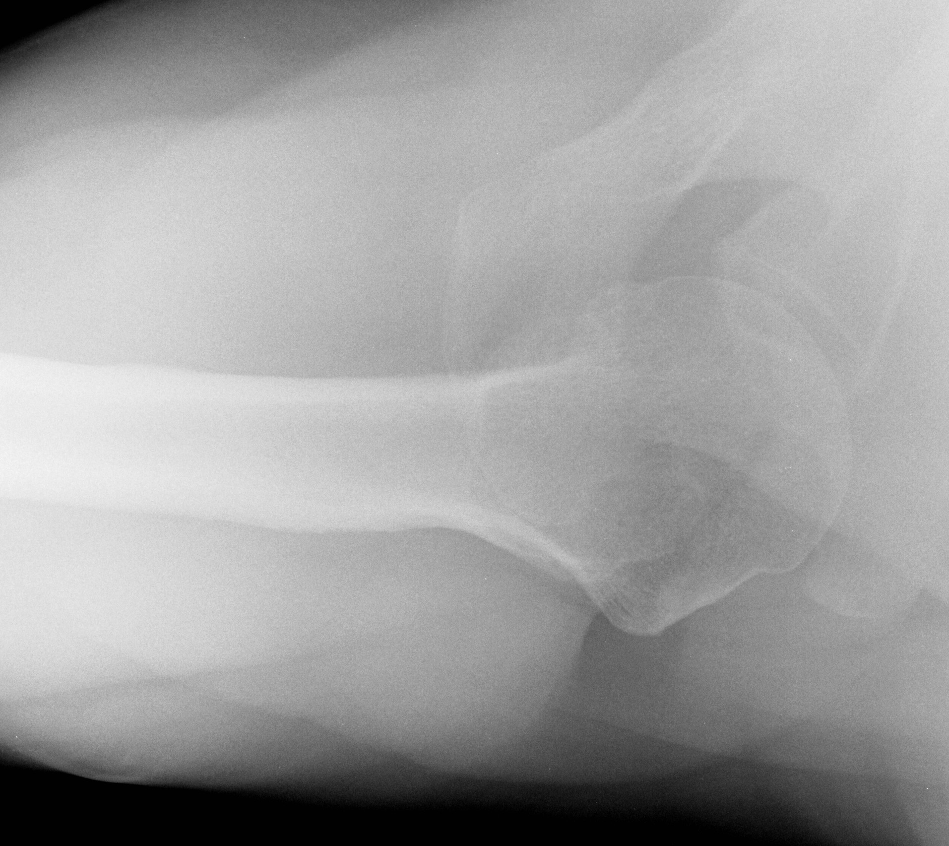 Shoulder Xrays | The Bone School