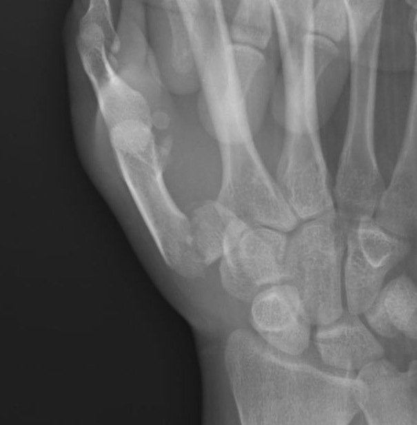 Base of thumb fractures | The Bone School