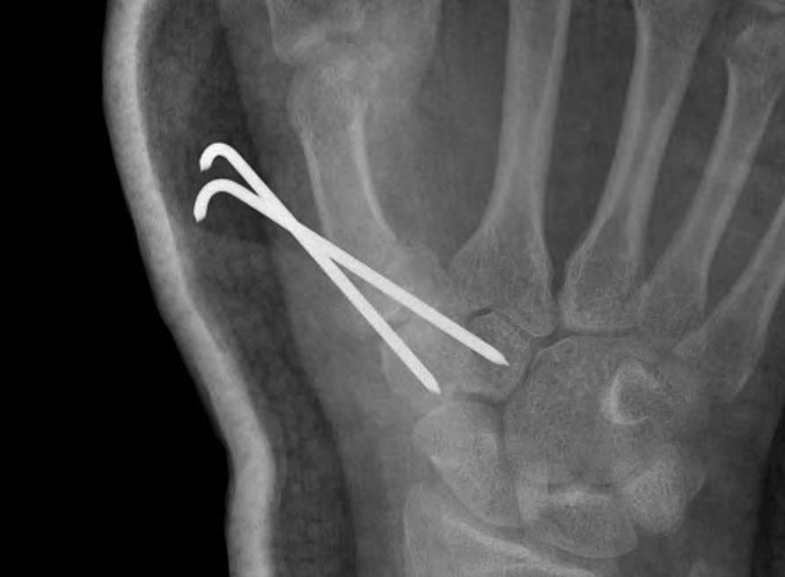 Base of thumb fractures | The Bone School