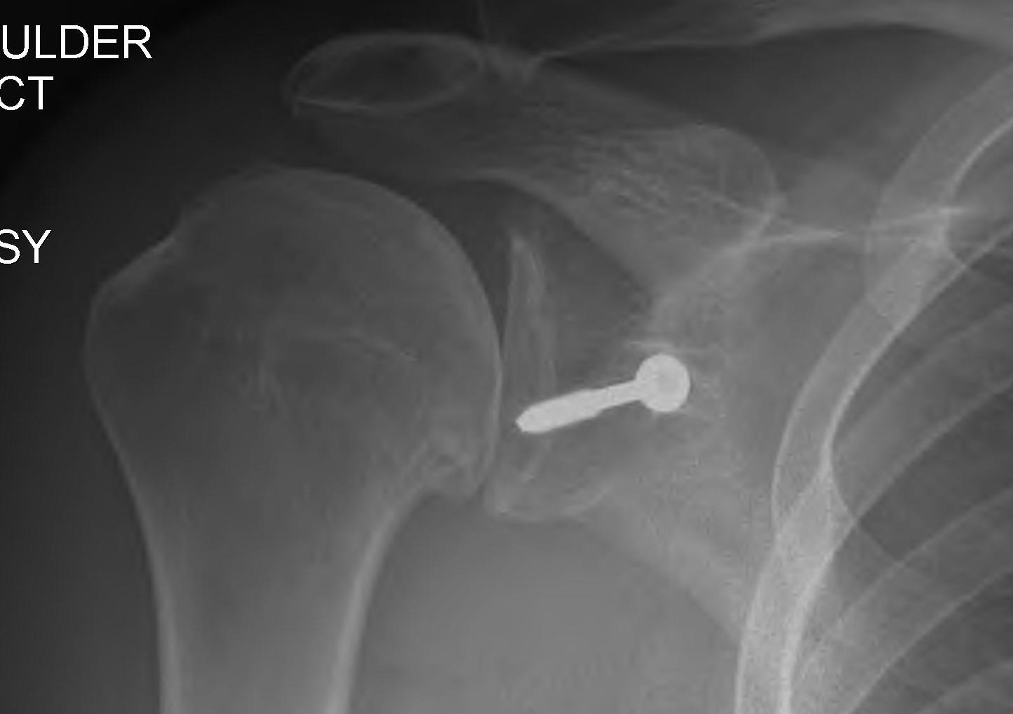 Latarjet / Bristow | The Bone School