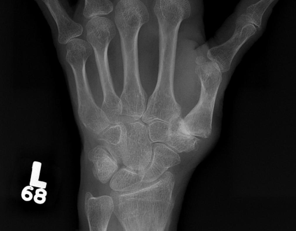 Base of Thumb OA | The Bone School