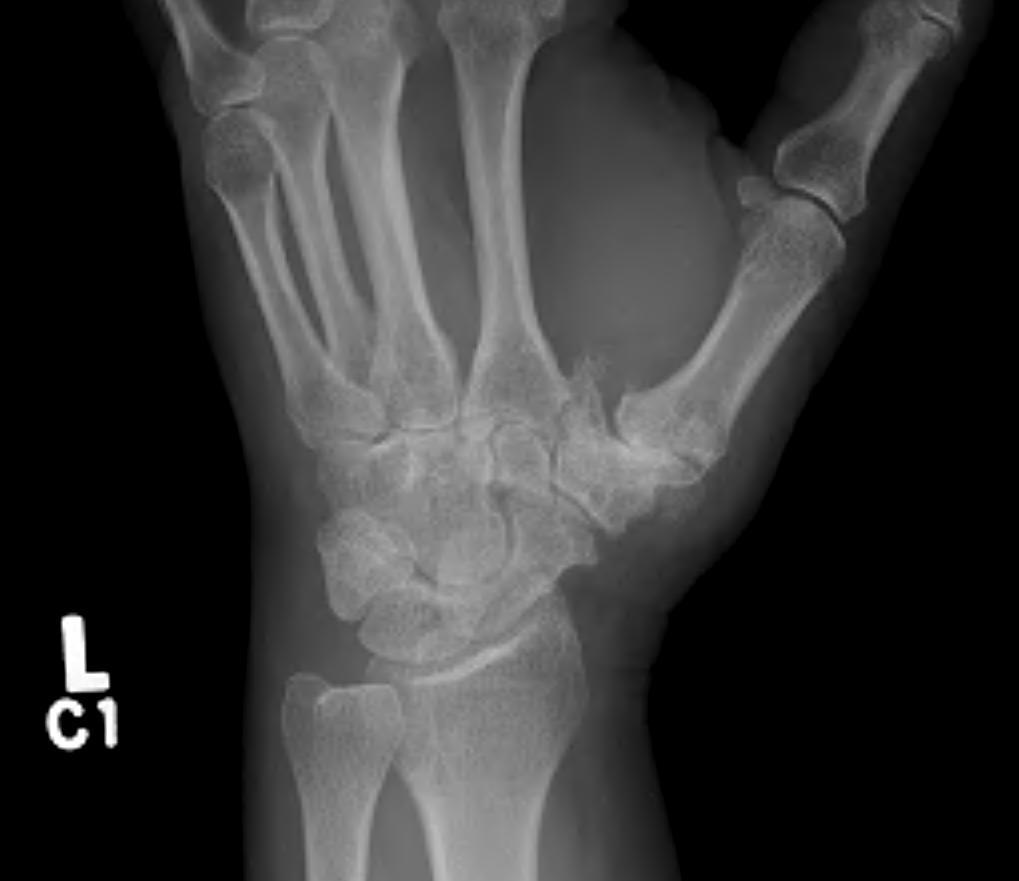 Base of Thumb OA | The Bone School