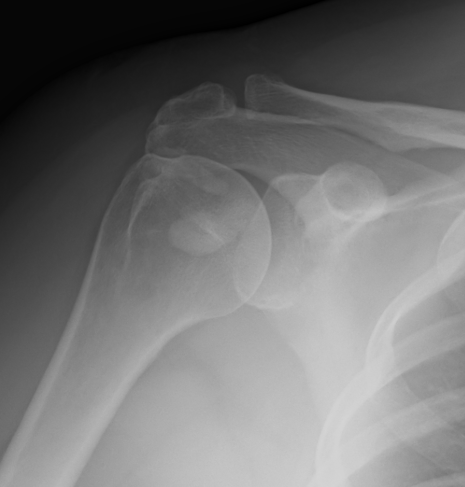 Calcific tendonitis | The Bone School