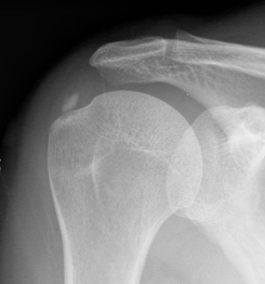 Shoulder Calcification