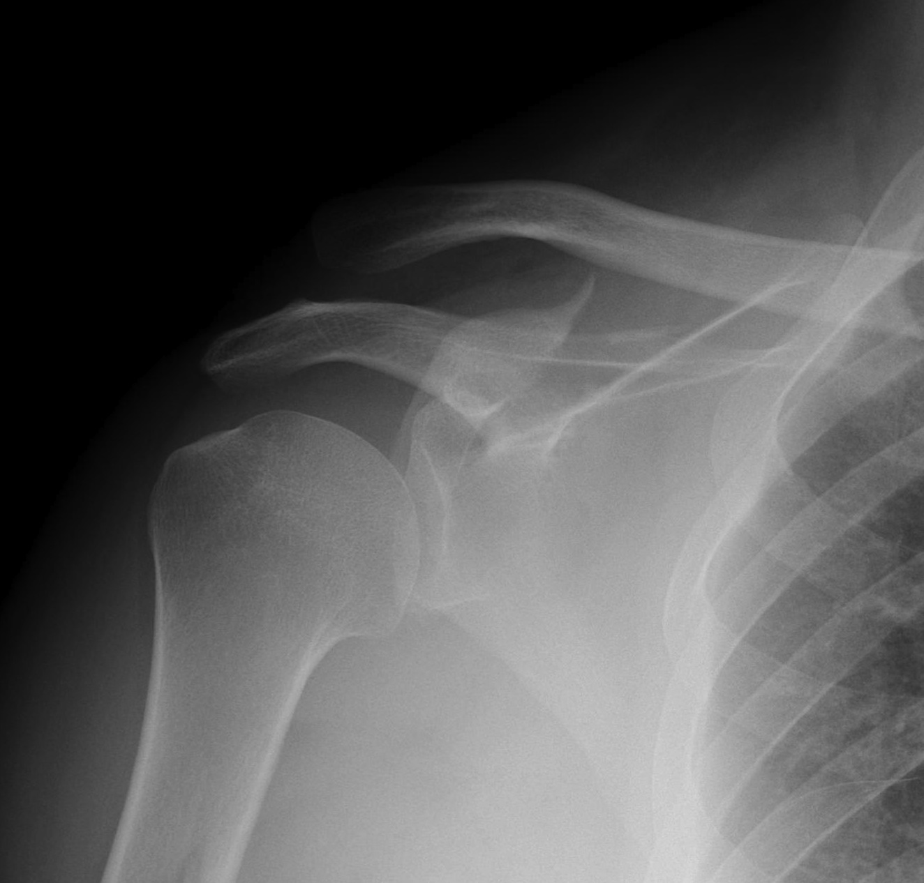 Coracoid process fractures | The Bone School