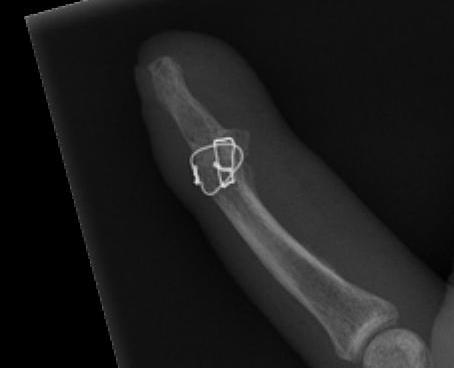 Osteoarthritis | The Bone School