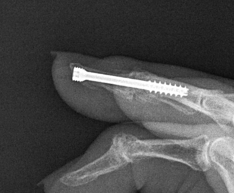 Osteoarthritis | The Bone School