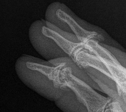 Inflammatory Arthritis | The Bone School