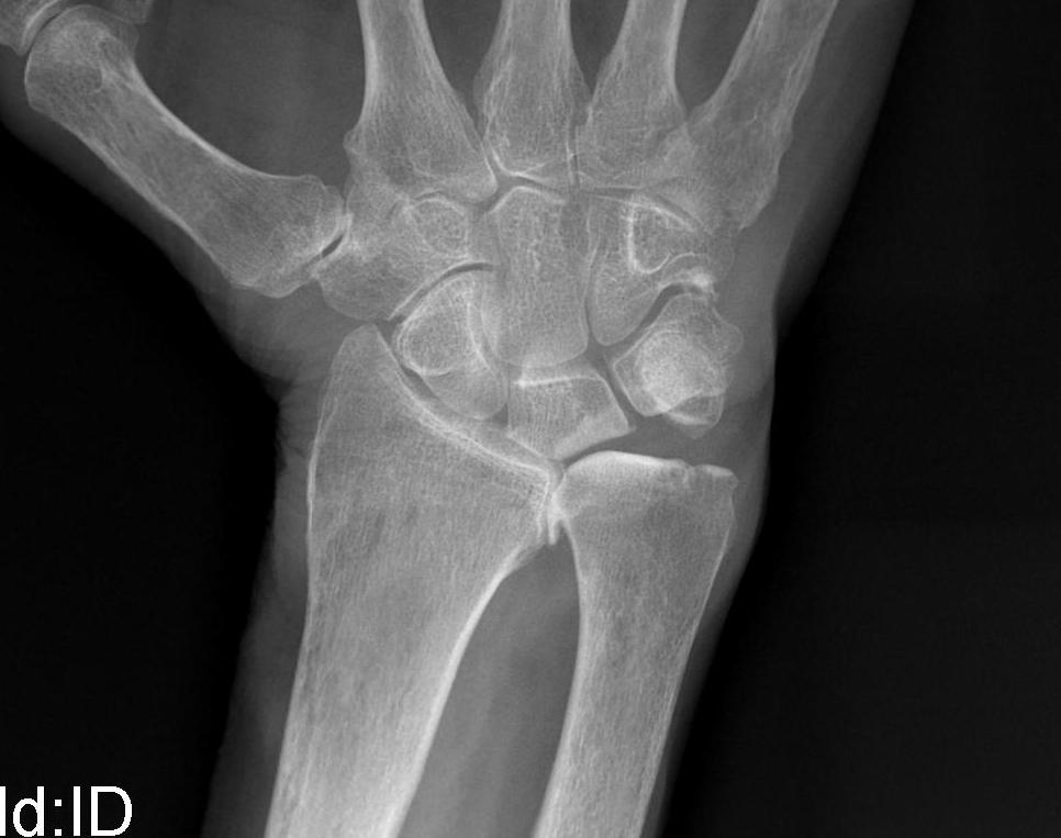 DRUJ Arthritis | The Bone School