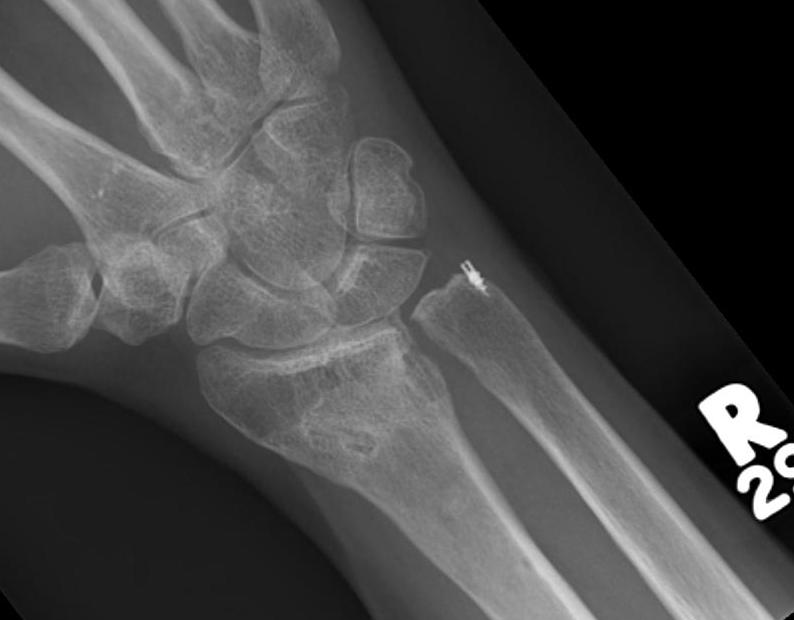 DRUJ Arthritis | The Bone School