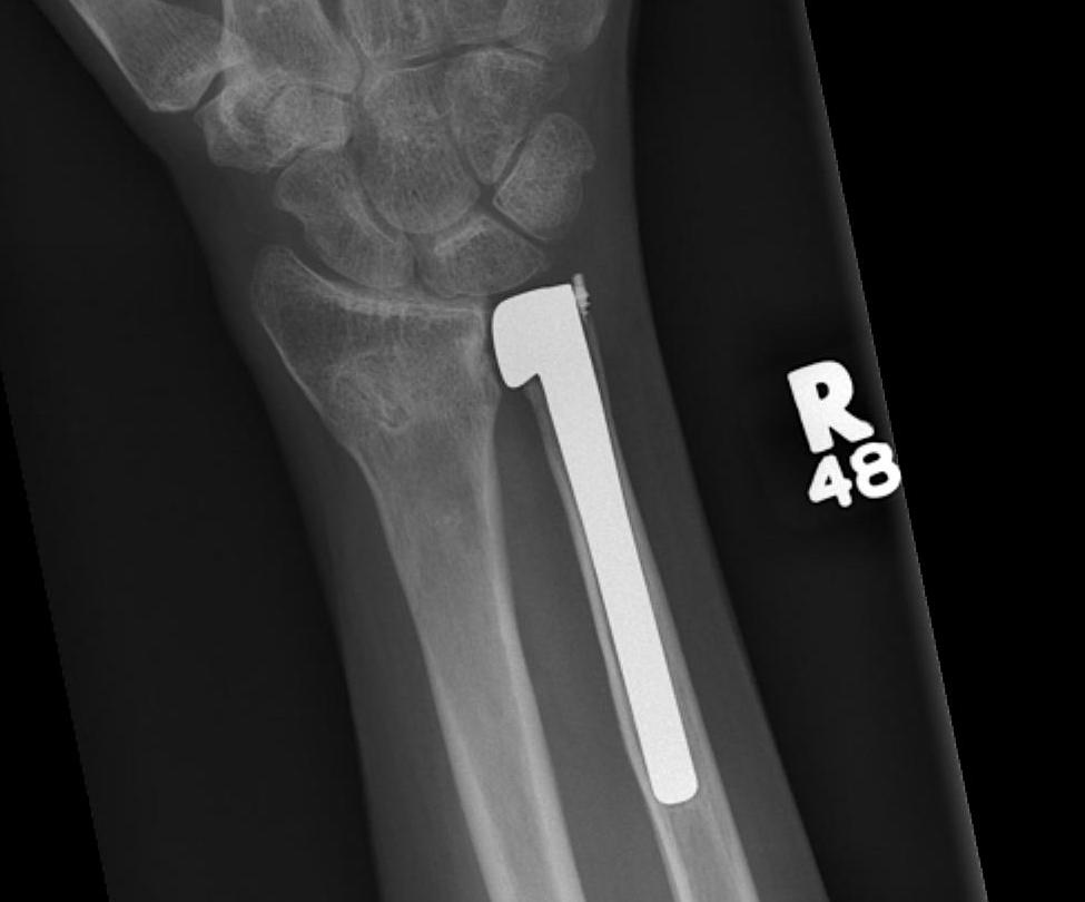 DRUJ Arthritis | The Bone School