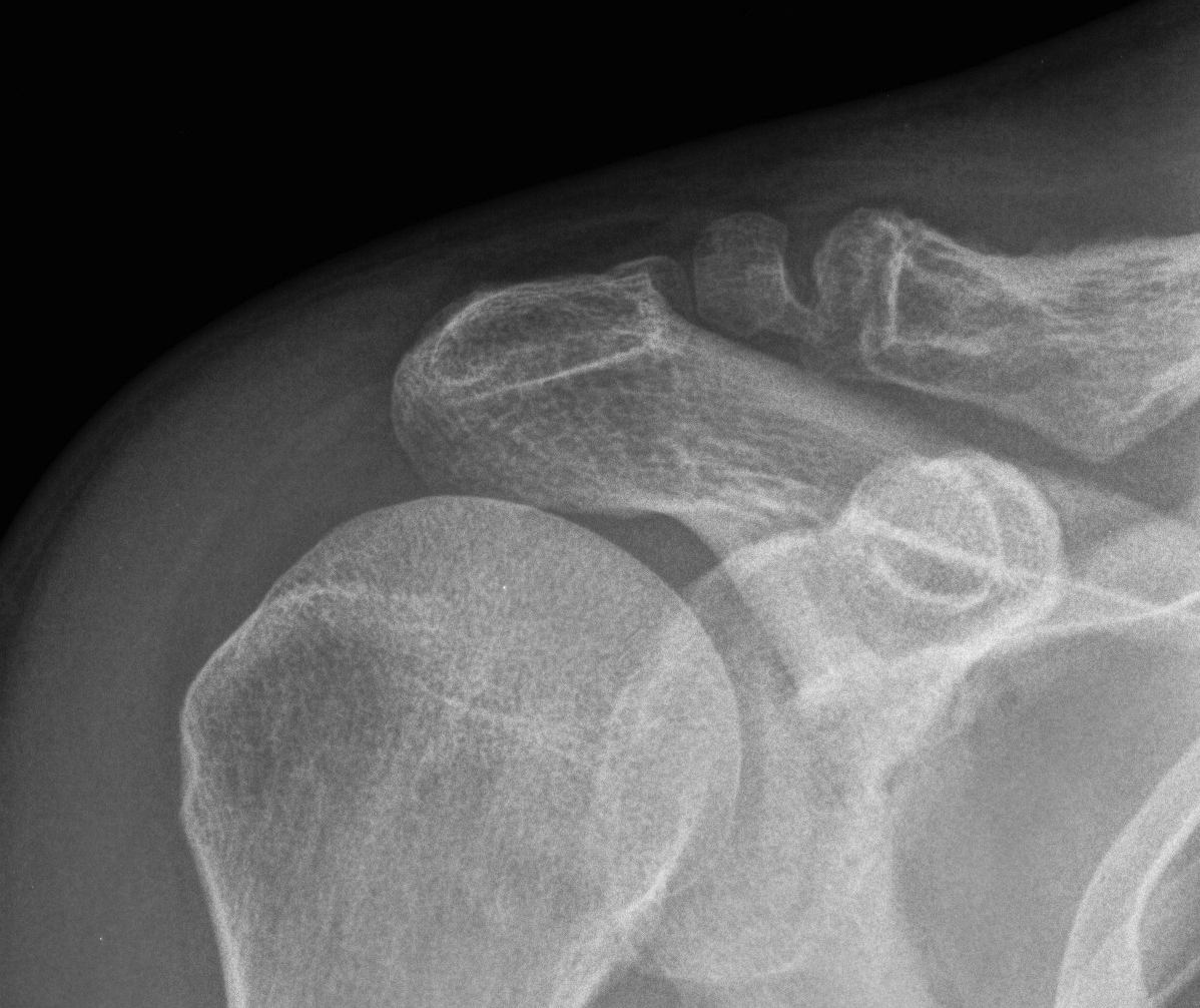 Lateral Clavicle Fracture | The Bone School