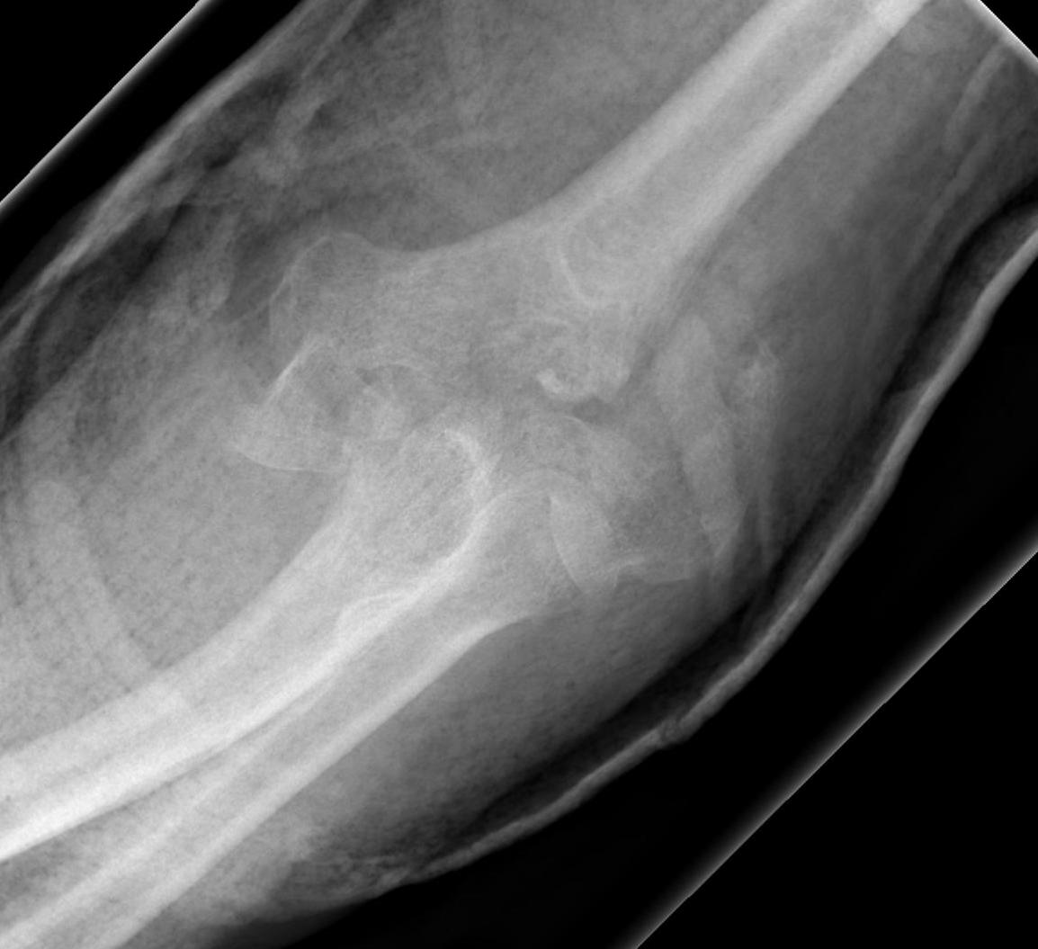 Intra-articular Distal Humerus Fractures | The Bone School