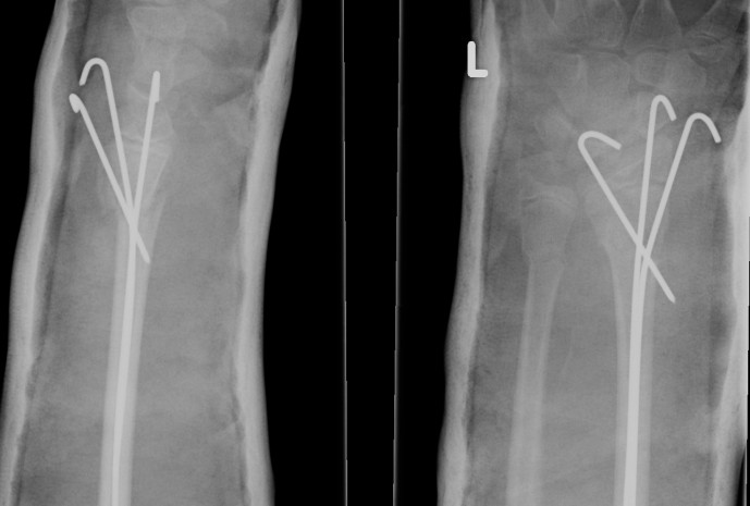 Distal radius fractures | The Bone School