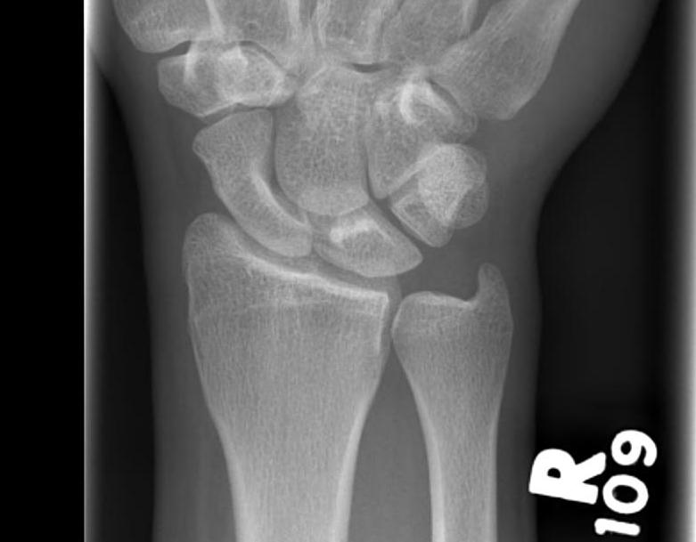 Distal Radius Fracture | The Bone School