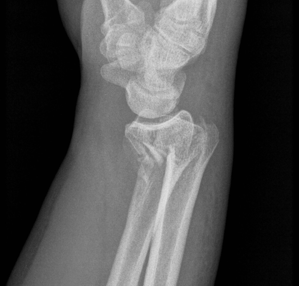 Smith Fracture X Ray