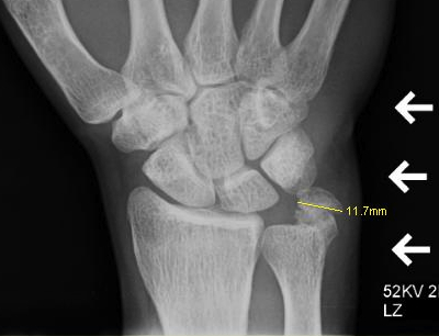 ECU Calcific Tendonitis | The Bone School