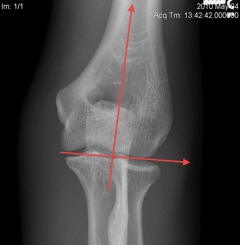 Simple elbow dislocation | The Bone School