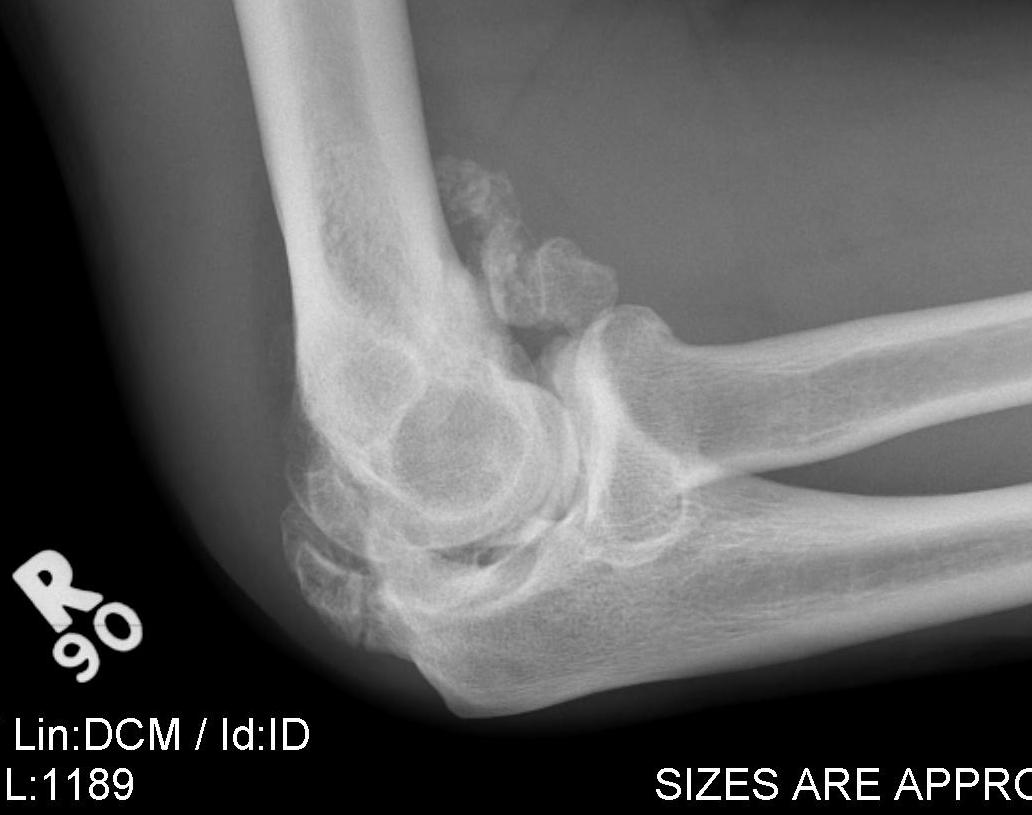 Heterotopic ossification | The Bone School