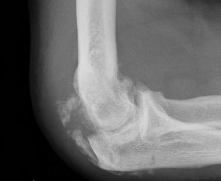 Heterotopic ossification | The Bone School