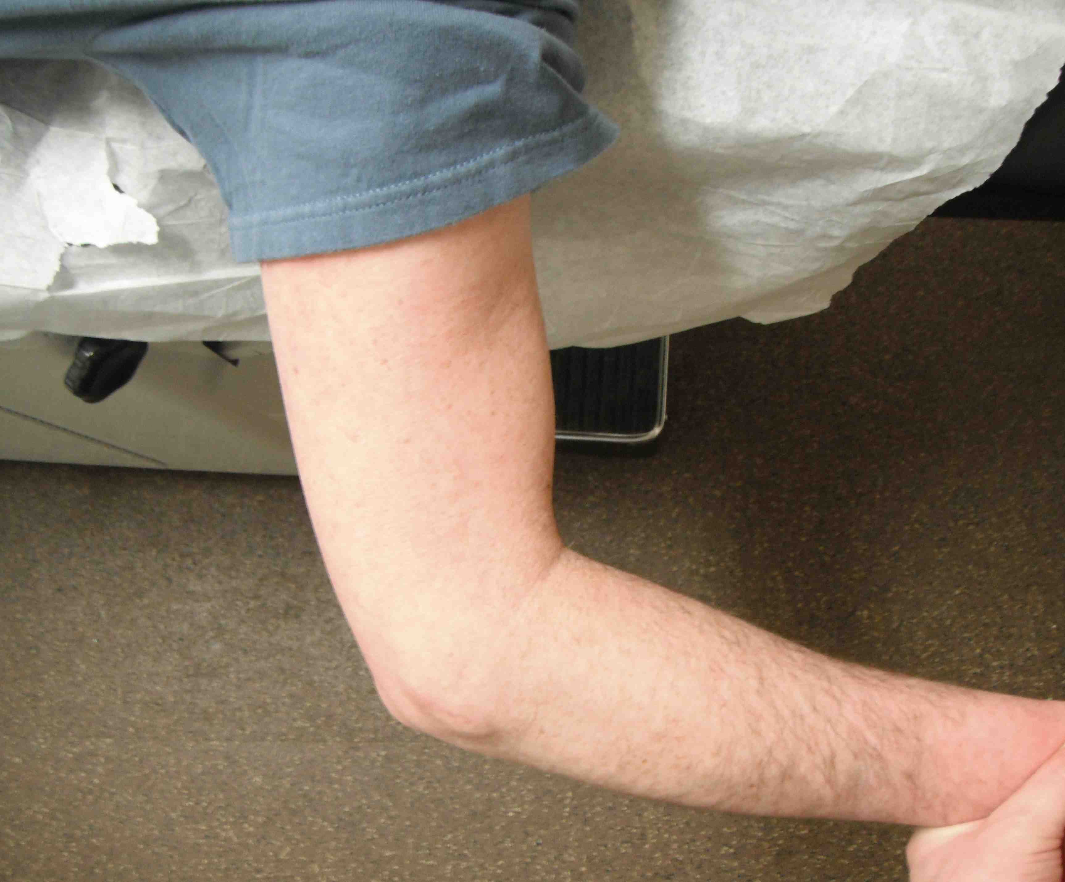 Ulna collateral ligament injury | The Bone School