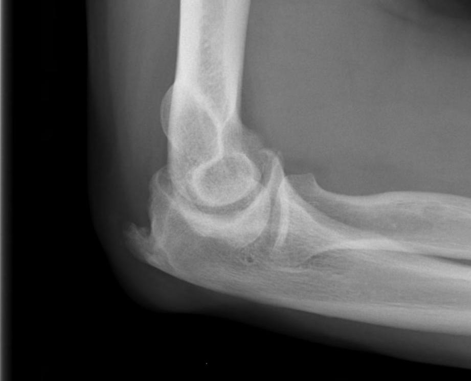 Osteoarthritis & stiffness | The Bone School