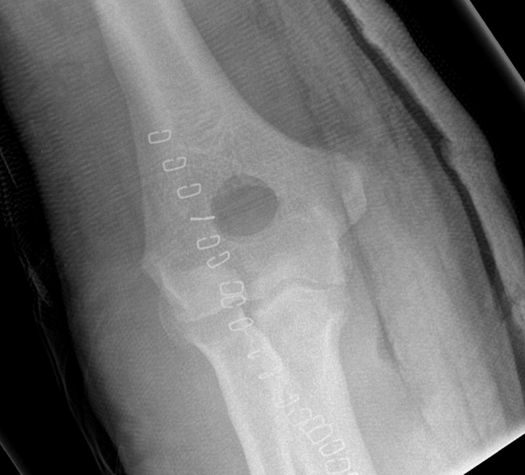 Osteoarthritis & stiffness | The Bone School