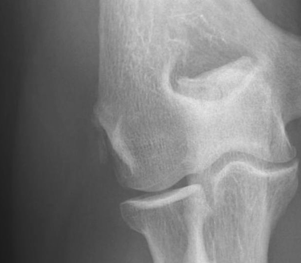 Lateral epicondylitis | The Bone School