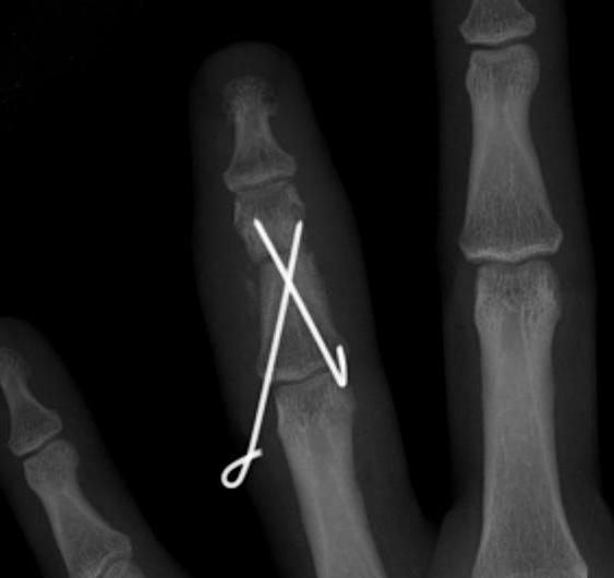 Finger | The Bone School