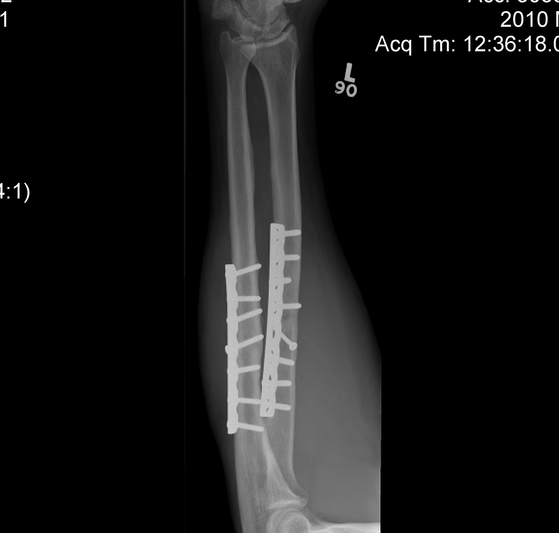 Ulna Bone Fracture
