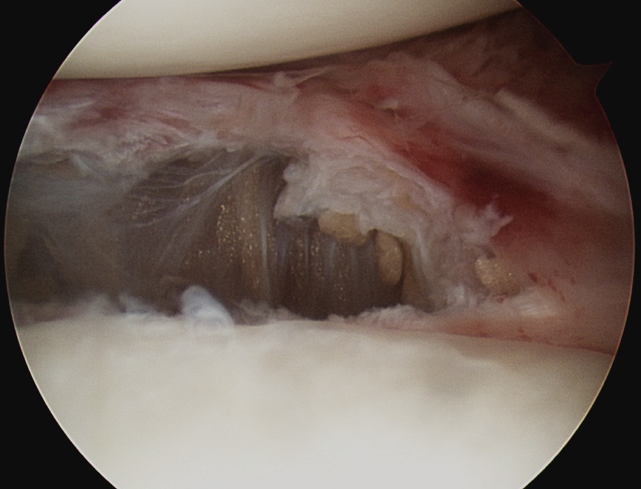 Adhesive capsulitis | The Bone School