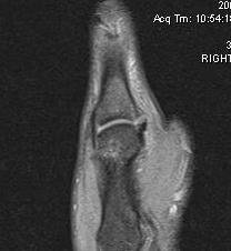 Gamekeepers Fracture