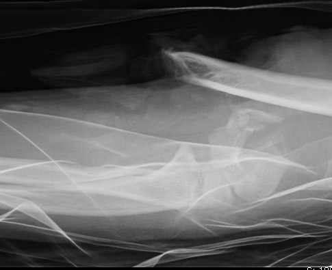 anterior humeral line | The Bone School