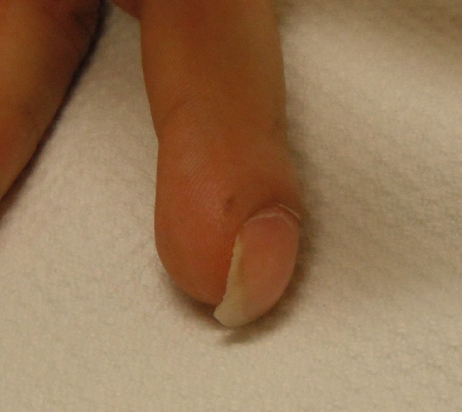 Nail Bed Lacerations | The Bone School