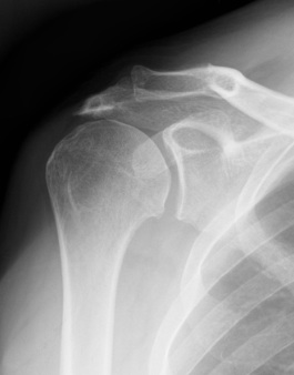 Impingement | The Bone School